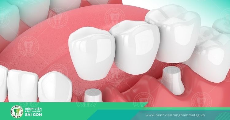 Nên bắc cầu răng sứ hay thực hiện trồng răng Implant?